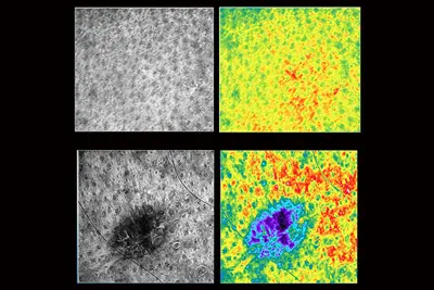 Physics Grad Student Wins Award for Skin Cancer Research | UMass Lowell